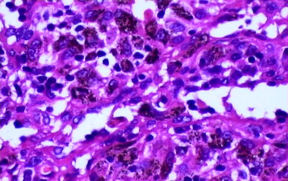 anthracosis lymph node