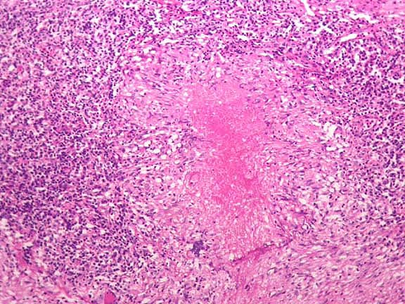 caseous necrosis lymph node