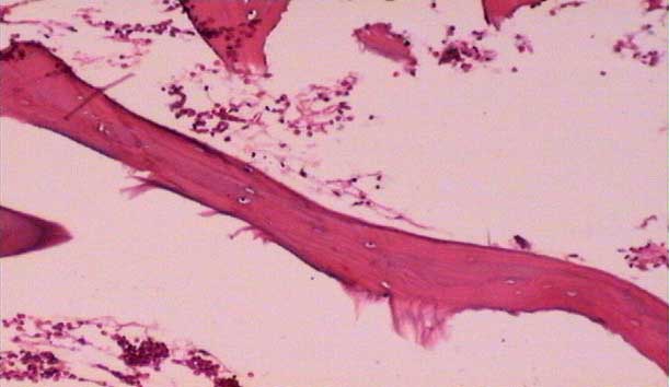 spicules bone marrow