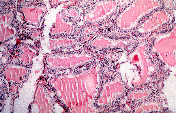 Thyroid Diffuse Hyperplasia