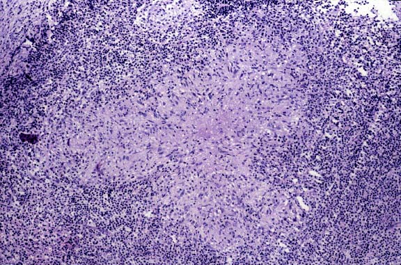 caseous necrosis lymph node