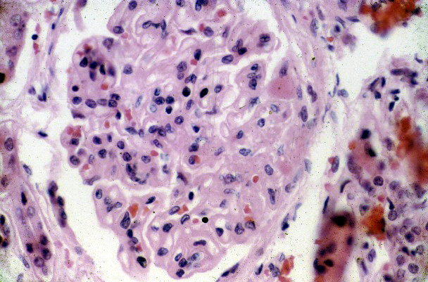 wire loop' glomerulonephritis